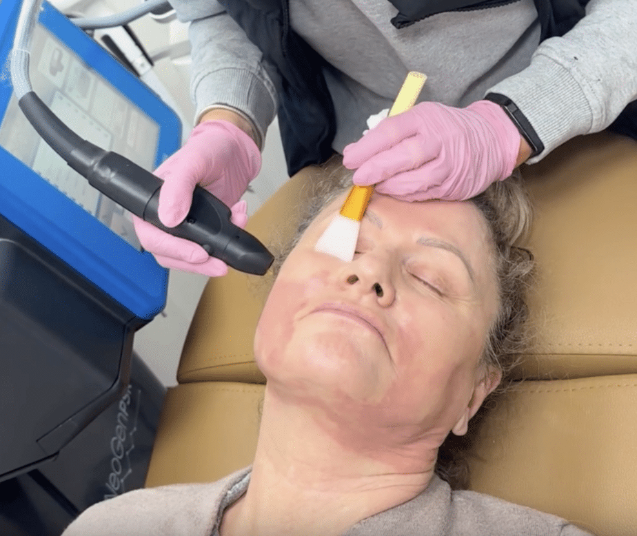 Does NeoGen Plasma Hurt? What to Expect During Treatment